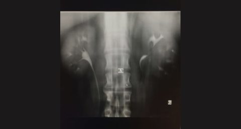 Urographie intra veineuse | Imagerie Loire Forez